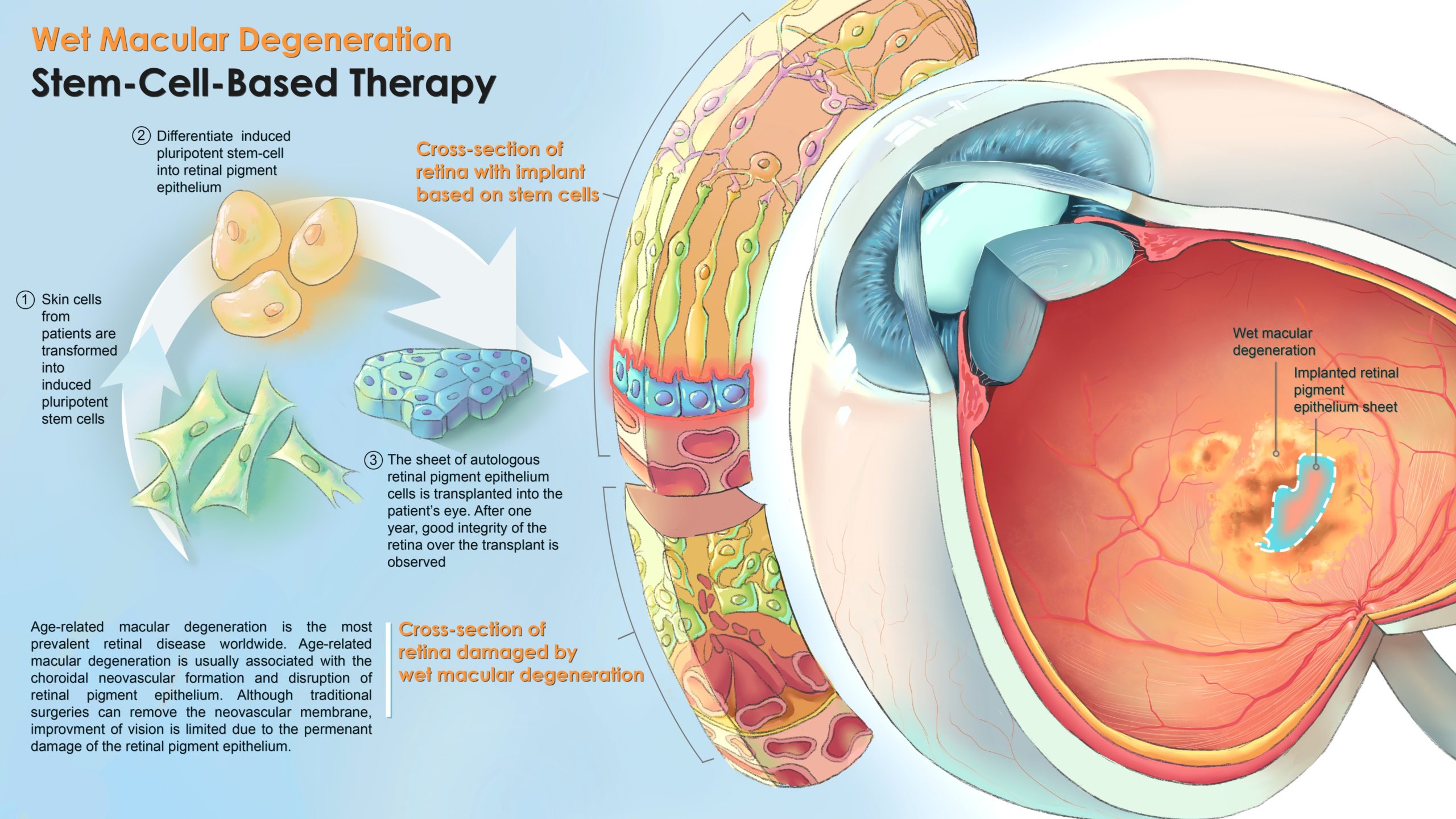 Stem-cell Based Therapy for AMD - ArtsEngine